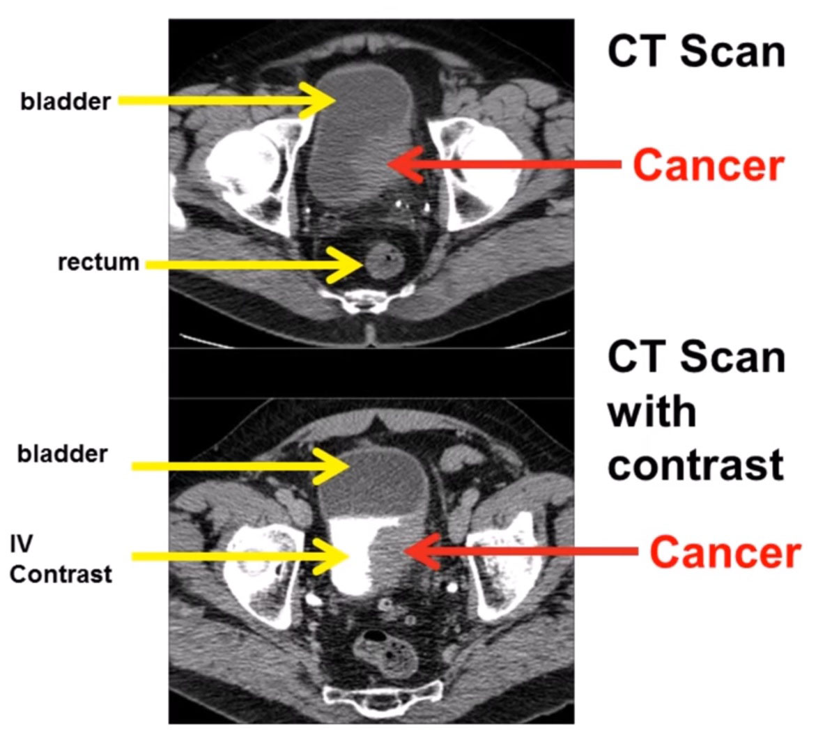 What Are The Symptoms Of Bladder Cancer Health For Best Life