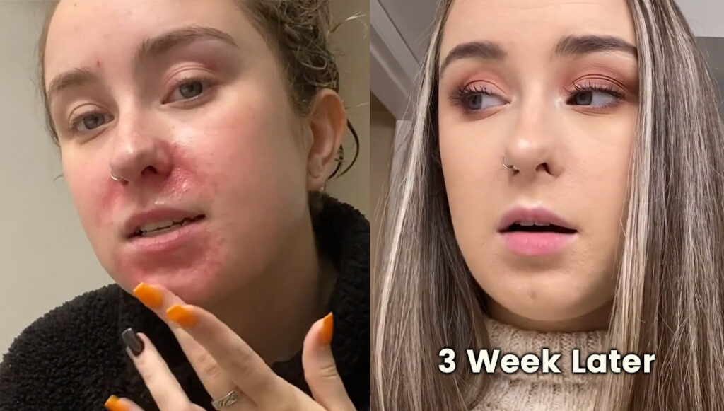 How To Get Rid Of Redness Around Nose Health For Best Life